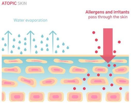 Eczema - discoid eczema