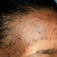 Acne vulgaris