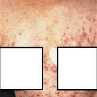 Acne vulgaris