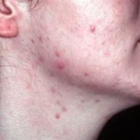 Acne vulgaris