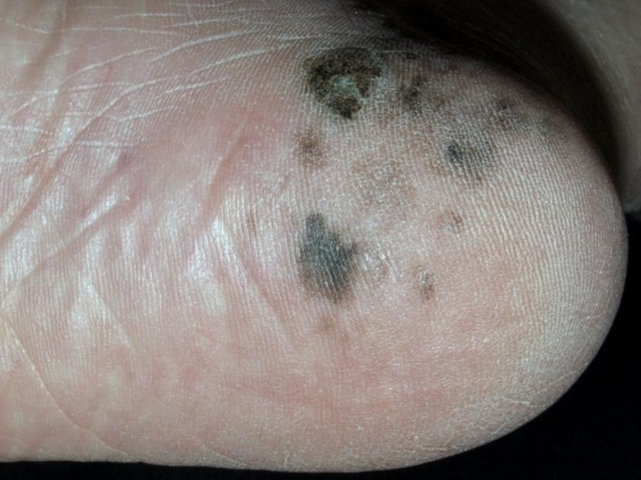 Acral Lentiginous Malignant Melanoma
