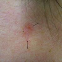 Morphoeic basal cell carcinoma