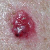 Basal cell carcinoma: solid (syn. nodular / cystic)