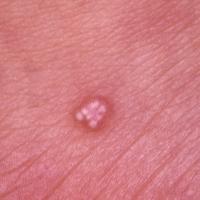 Calcification of the skin and subcutaneous tissues