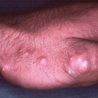 Calcification of the skin and subcutaneous tissues