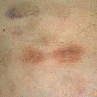 Calcification of the skin and subcutaneous tissues