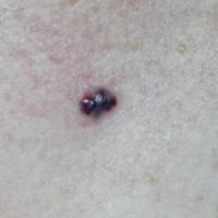 Angioma