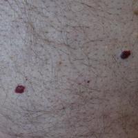 Angioma