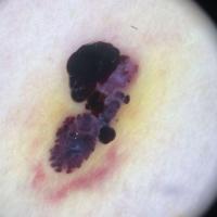 Angioma