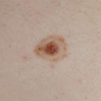 Cockade naevus (syn. Naevus en cocarde)