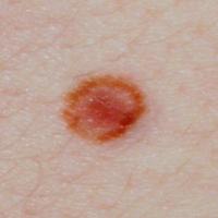 Cockade naevus (syn. Naevus en cocarde)