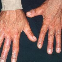 Contact allergic dermatitis