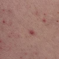 Folliculitis and furuncles / carbuncles (boils)