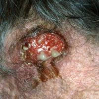 Folliculitis and furuncles / carbuncles (boils)