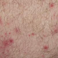 Folliculitis and furuncles / carbuncles (boils)