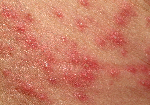 Folliculitis and furuncles / carbuncles (boils)