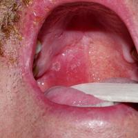 Herpes zoster (syn. shingles)