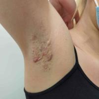 Hidradenitis suppurativa (syn. acne inversa)