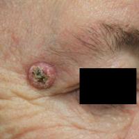 Keratoacanthoma