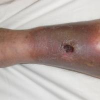 Leg ulcers