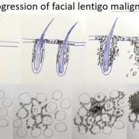 Lentigo maligna