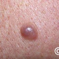 Melanoma