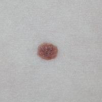 Benign melanocytic naevi