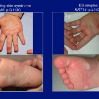 Peeling skin conditions