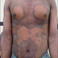 Peeling skin conditions