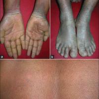 Peeling skin conditions