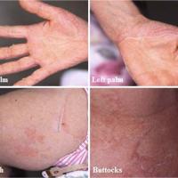 Peeling skin conditions