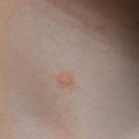 Pityriasis lichenoides