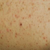 Pityriasis lichenoides