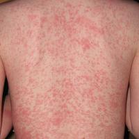 Polymorphic light eruption & juvenile spring eruption