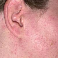 Polymorphic light eruption & juvenile spring eruption