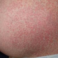 Polymorphous eruption of pregnancy