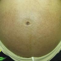 Polymorphous eruption of pregnancy