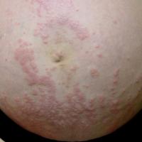 Pregnancy related skin conditions - an overview