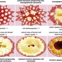 Squamous cell carcinoma