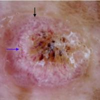Squamous cell carcinoma