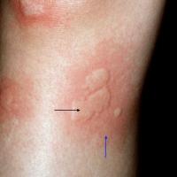 Spontaneous urticaria, chronic ordinary urticaria