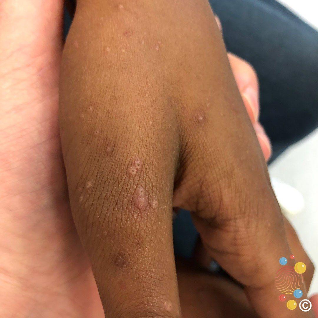 mollusca skin examples