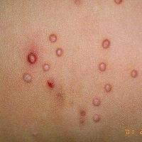 Molluscum contagiosum