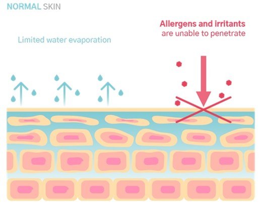 Eczema - discoid eczema