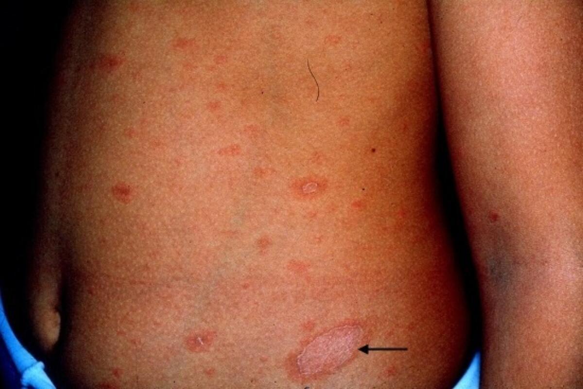Pityriasis Rosea Pityriasis Rosea – BASUK DERMATOLOGY