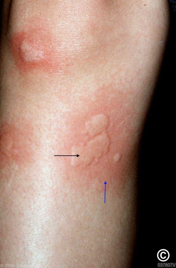 Urticaria and angioedema