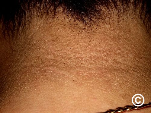 Acanthosis nigricans