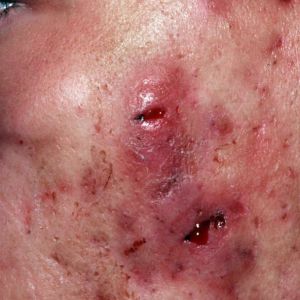Acne conglobata