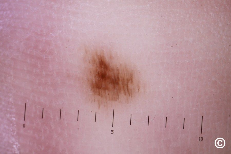 Acral-lentiginous melanoma