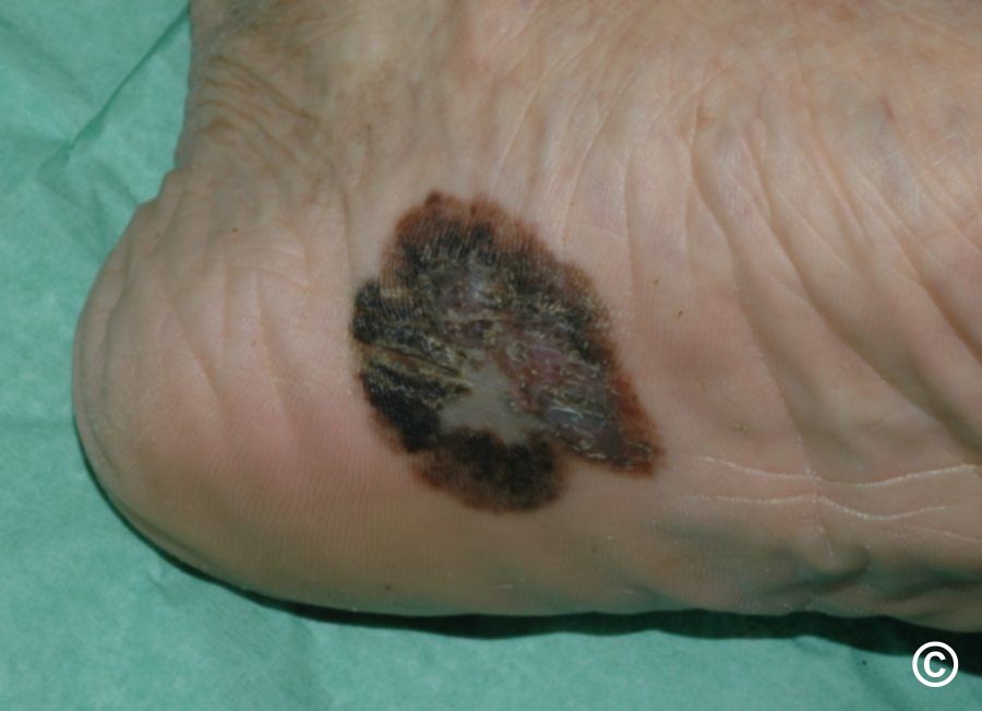 Malignant Melanoma Foot